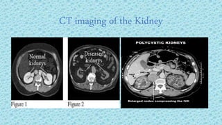 Ct stonogram-final-slide-share (Amponin & Carampatan) | PPTX