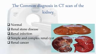 Ct stonogram-final-slide-share (Amponin & Carampatan) | PPTX