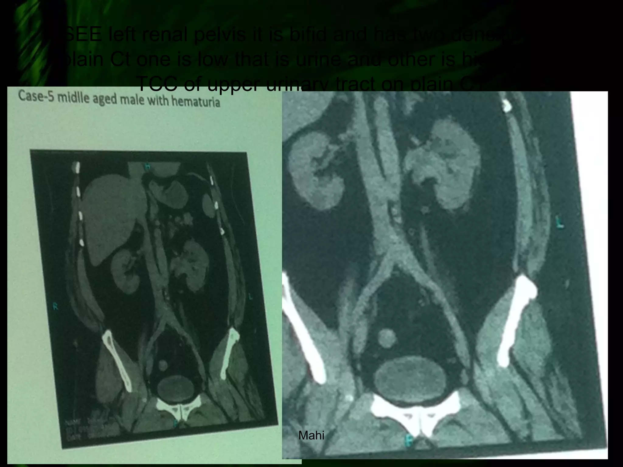 Ct urinary system in radiology | PPT