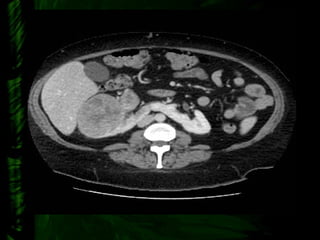 Ct urinary system in radiology | PPT