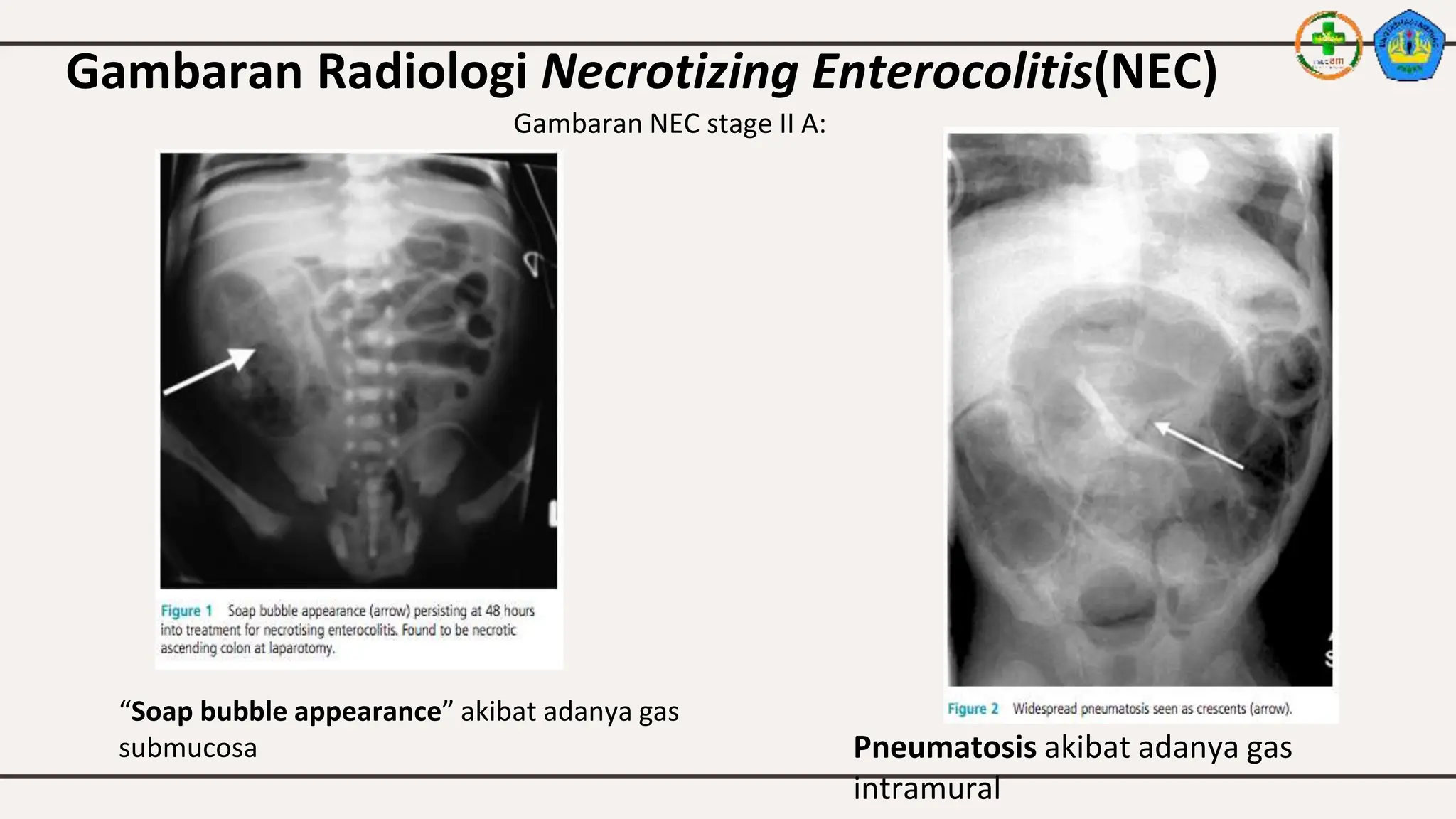 CT 6_Ileus Paralitik pada Neonatal _ Perbedaan Secara Radiologis dengan ...