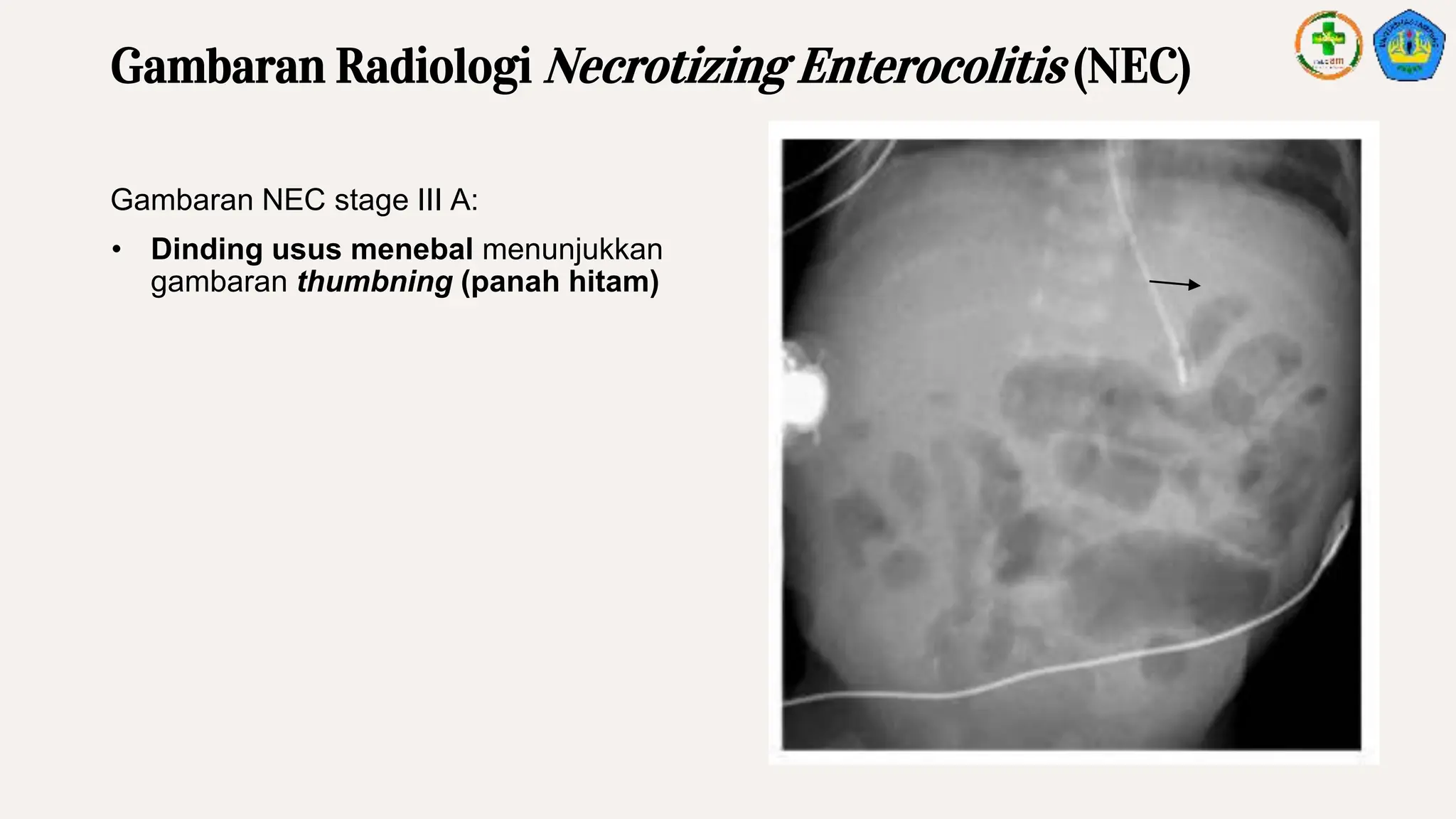 CT 6_Ileus Paralitik pada Neonatal _ Perbedaan Secara Radiologis dengan ...