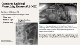 CT 6_Ileus Paralitik pada Neonatal _ Perbedaan Secara Radiologis dengan ...