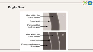 CT 6_Ileus Paralitik pada Neonatal _ Perbedaan Secara Radiologis dengan ...