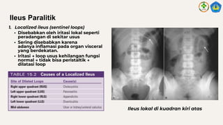 CT 6_Ileus Paralitik pada Neonatal _ Perbedaan Secara Radiologis dengan ...