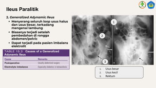 CT 6_Ileus Paralitik pada Neonatal _ Perbedaan Secara Radiologis dengan ...