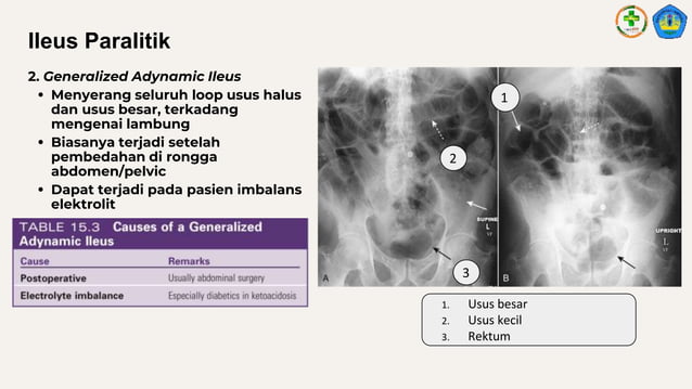 CT 6_Ileus Paralitik pada Neonatal _ Perbedaan Secara Radiologis dengan ...