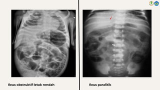 CT 6_Ileus Paralitik pada Neonatal _ Perbedaan Secara Radiologis dengan ...
