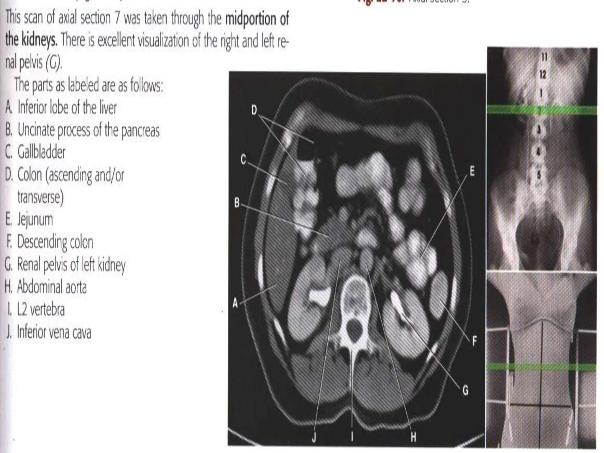 CT scan ABDOMEN Explained توضیحات سی تی اسکن شکم ولگن.ppt