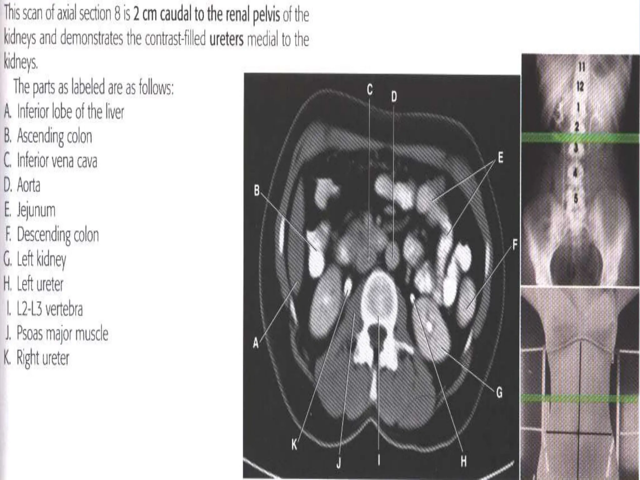 CT scan ABDOMEN Explained توضیحات سی تی اسکن شکم ولگن.ppt