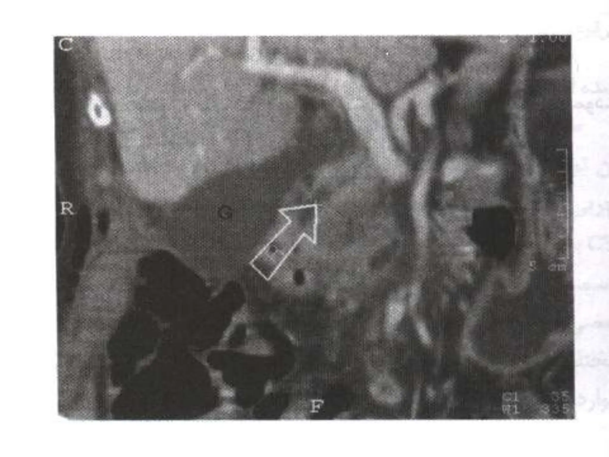 CT scan ABDOMEN Explained توضیحات سی تی اسکن شکم ولگن.ppt