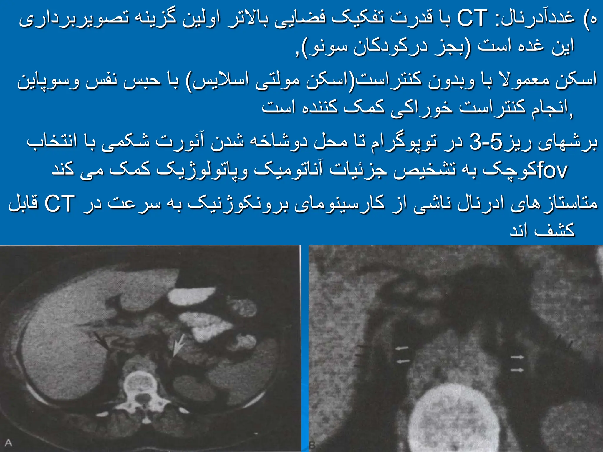 CT scan ABDOMEN Explained توضیحات سی تی اسکن شکم ولگن.ppt
