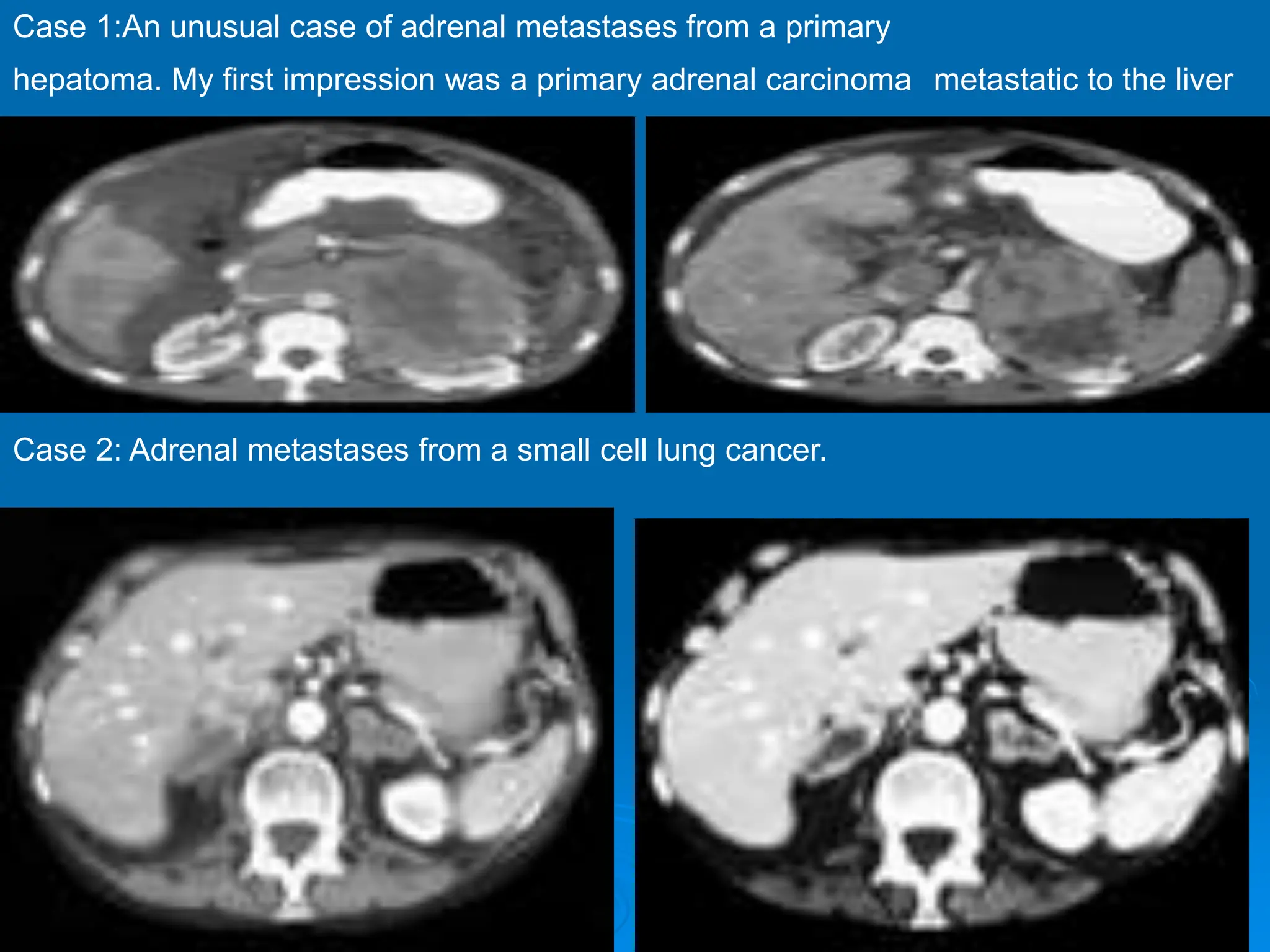 CT scan ABDOMEN Explained توضیحات سی تی اسکن شکم ولگن.ppt