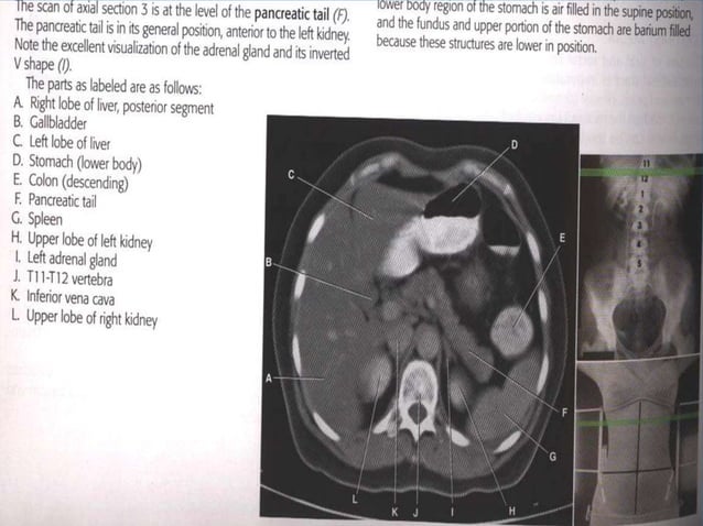CT scan ABDOMEN Explained توضیحات سی تی اسکن شکم ولگن.ppt