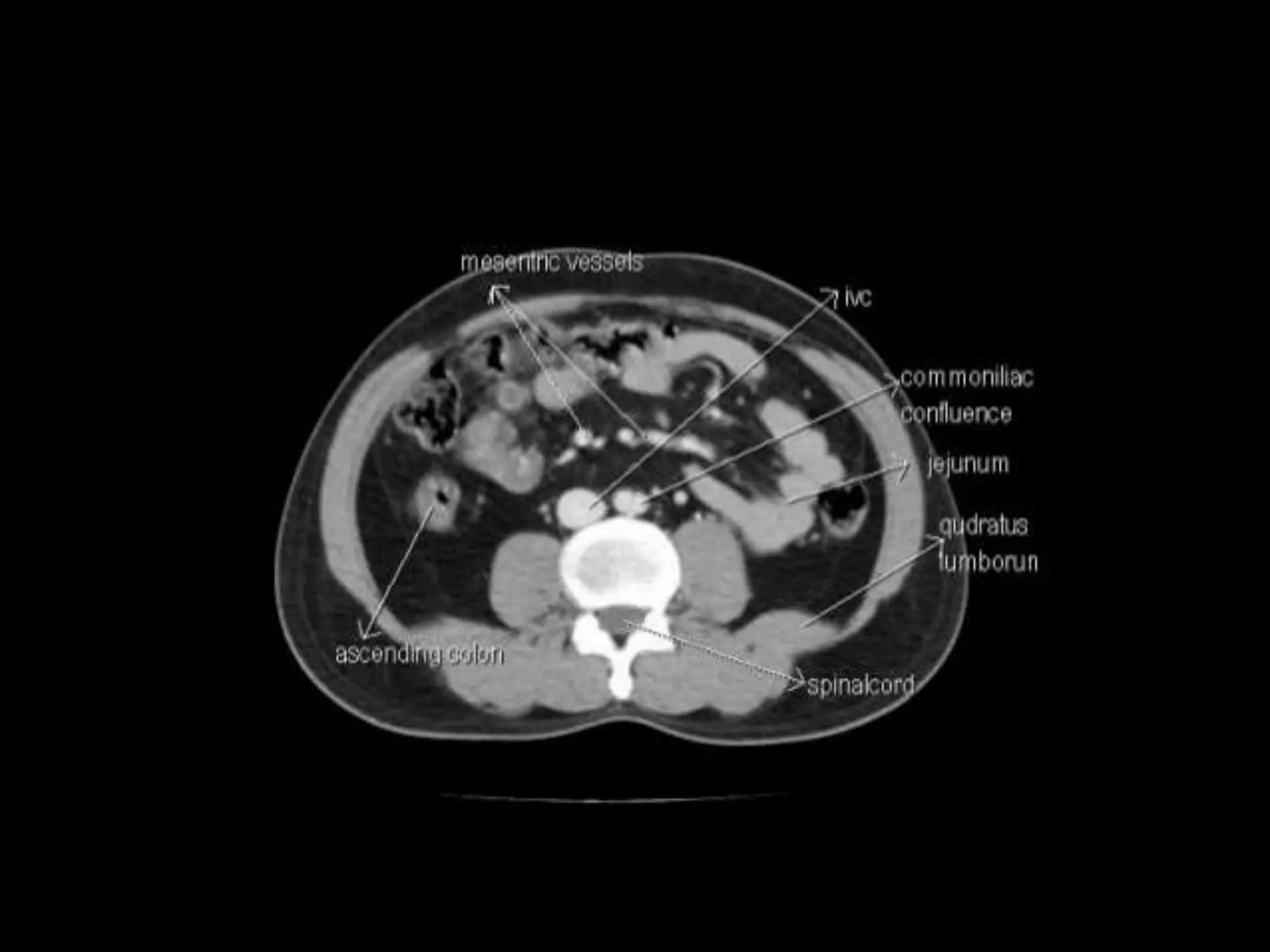 CT ABDOMEN ANATOMY | PPTX