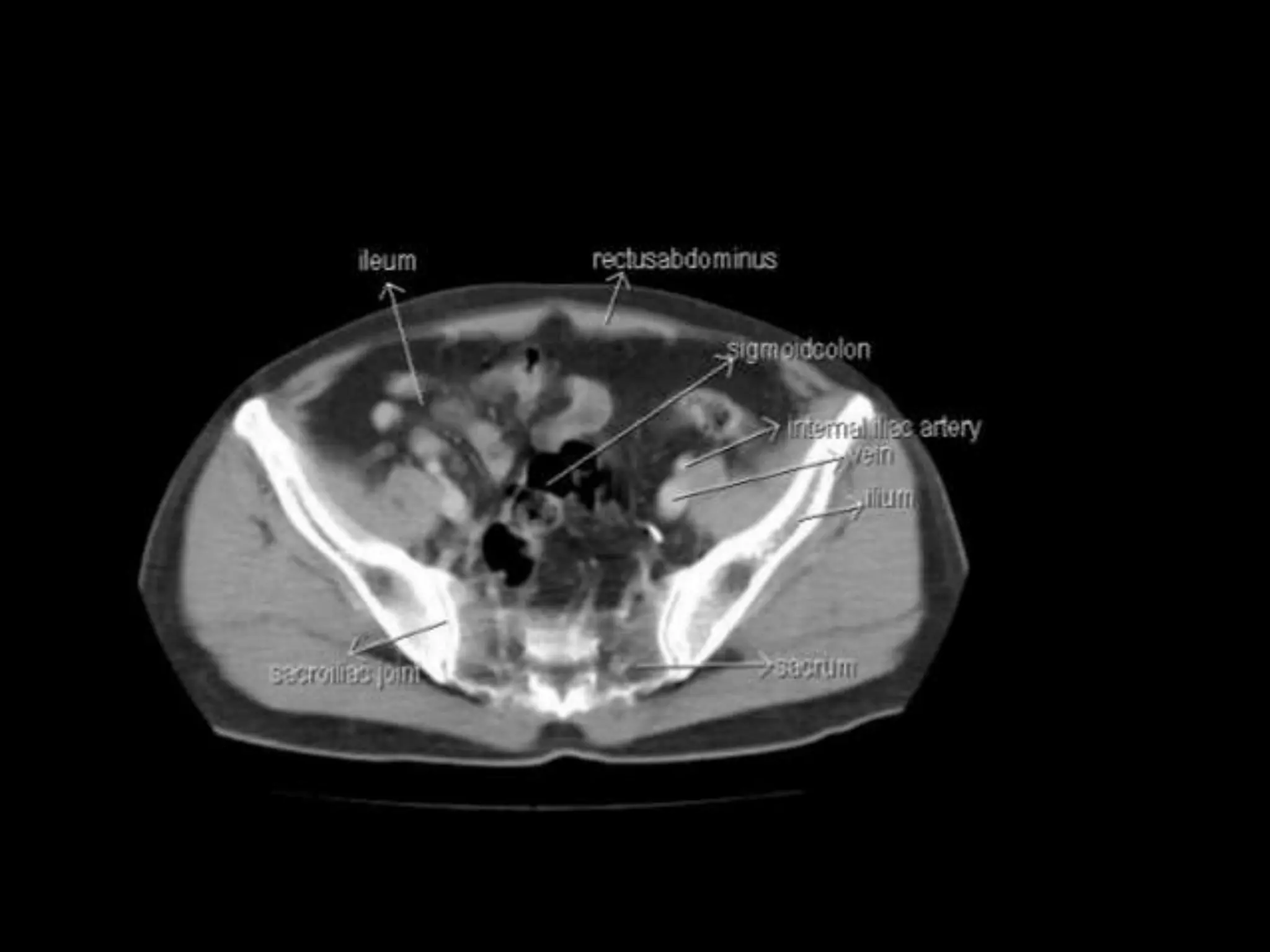 CT ABDOMEN ANATOMY | PPTX