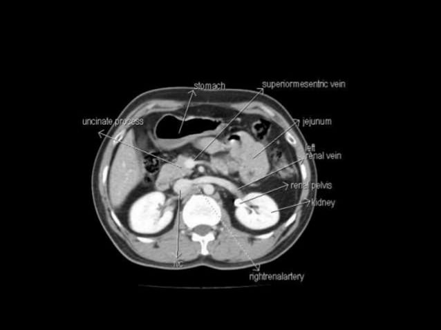 CT ABDOMEN ANATOMY | PPTX