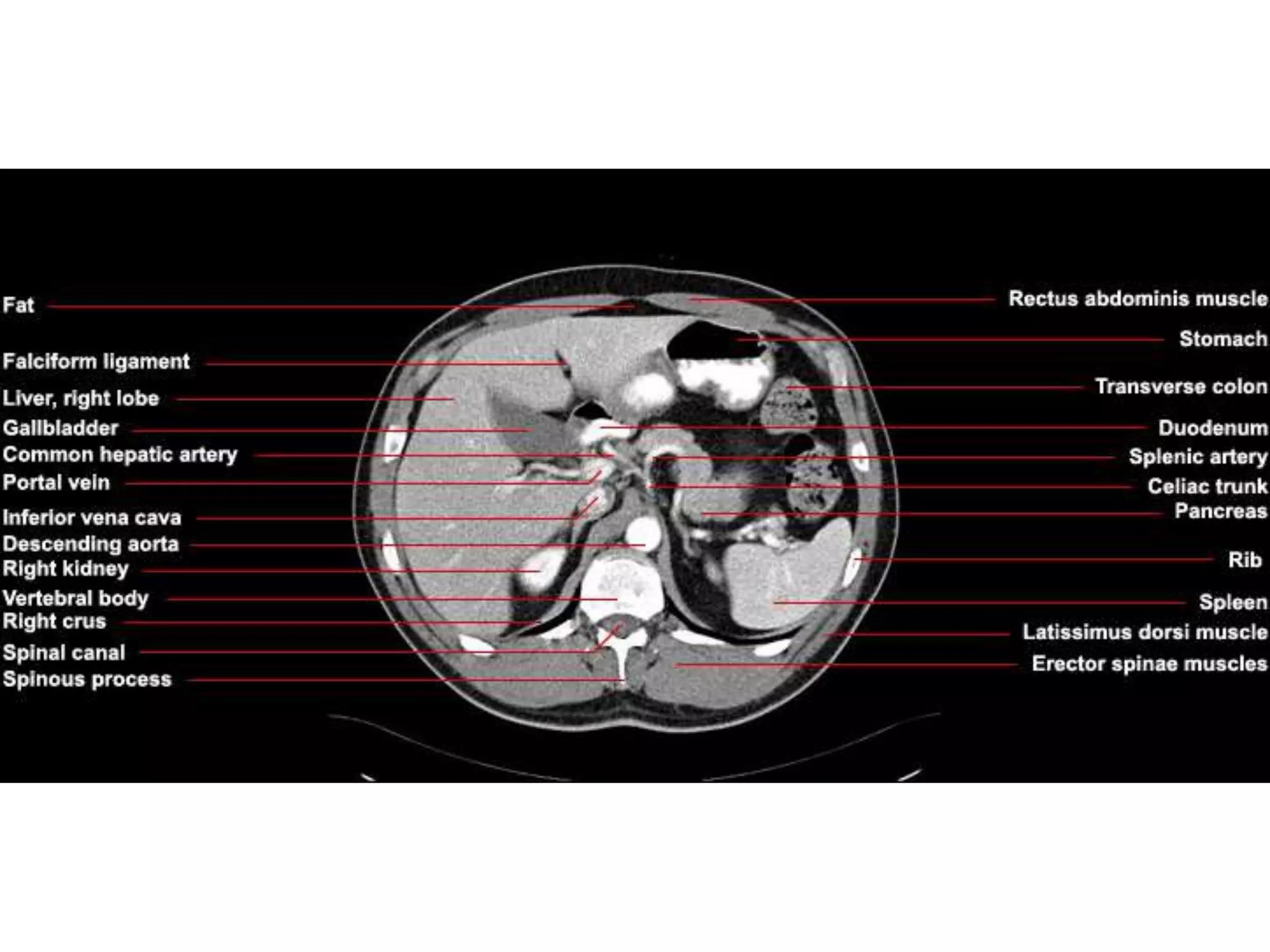 CT Abdomen Axial.pptx