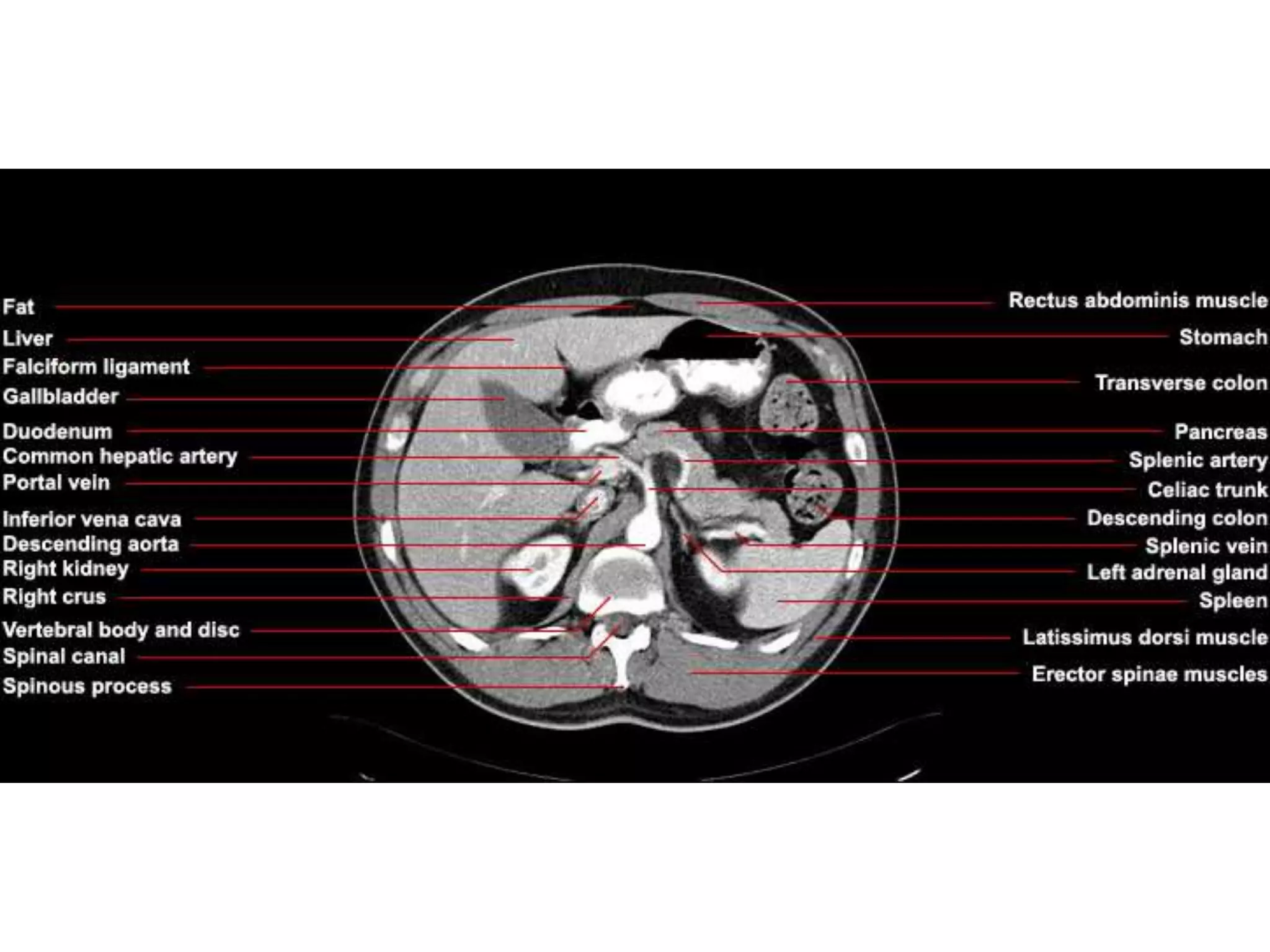 CT Abdomen Axial.pptx
