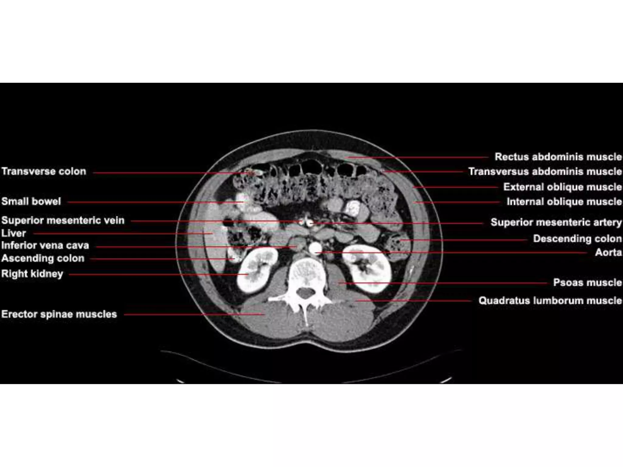 CT Abdomen Axial.pptx