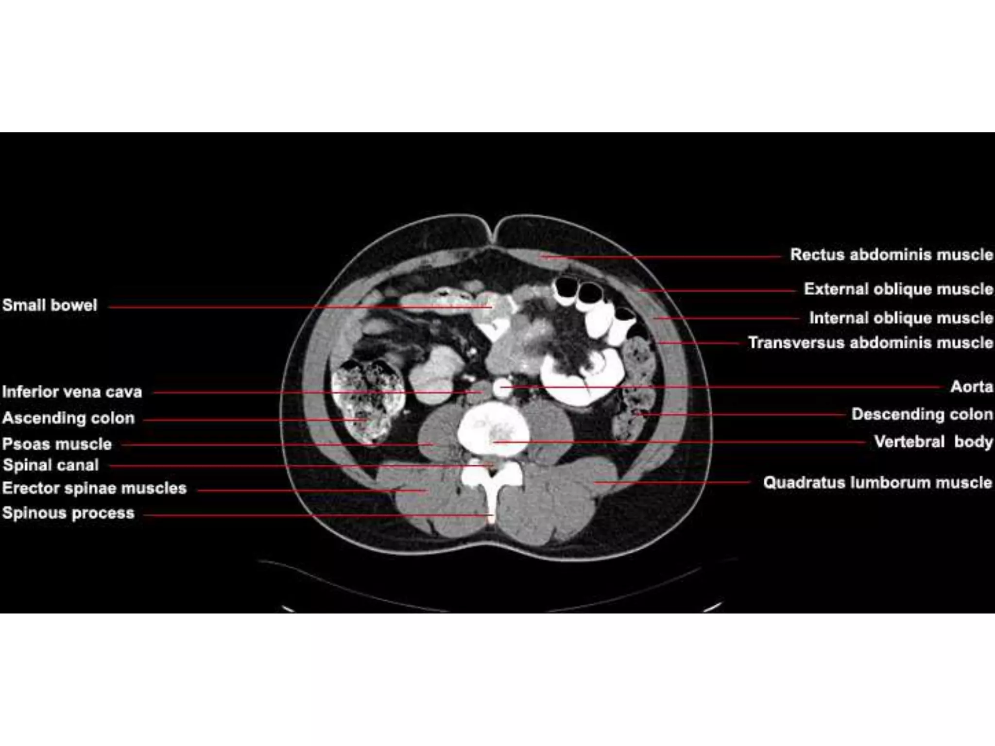 CT Abdomen Axial.pptx
