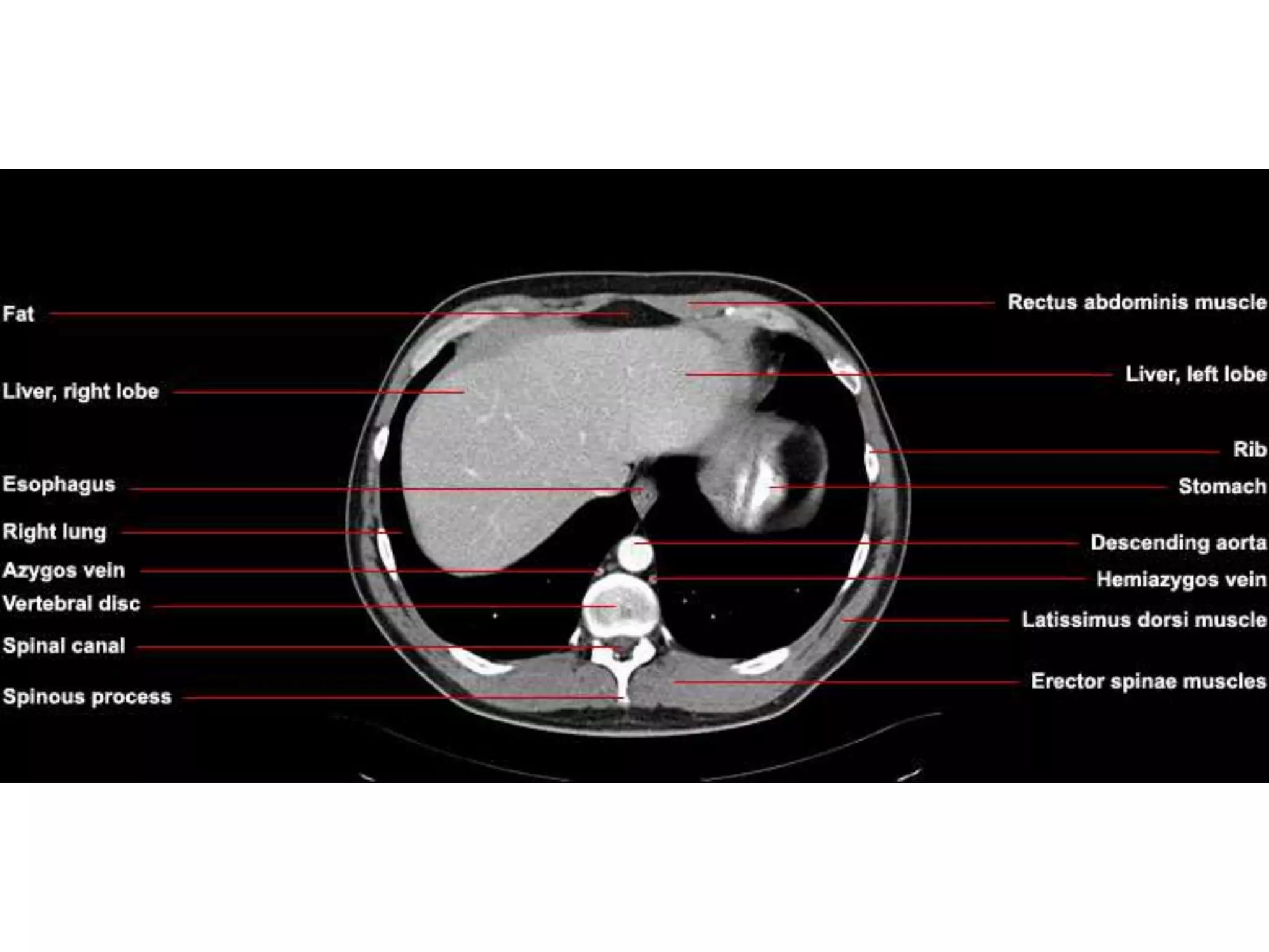 CT Abdomen Axial.pptx