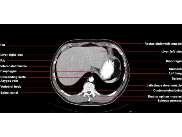 CT Abdomen Axial.pptx