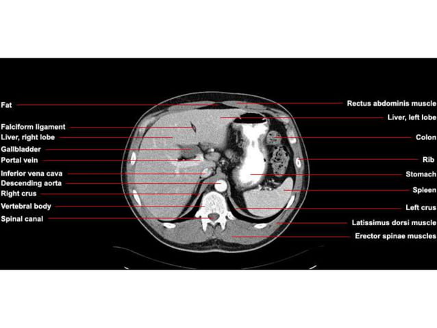 CT Abdomen Axial.pptx