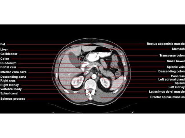 CT Abdomen Axial.pptx