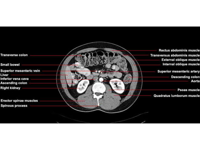 CT Abdomen Axial.pptx
