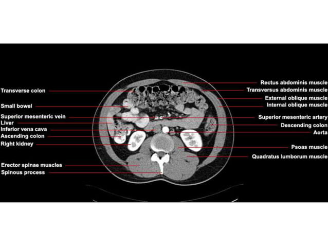 CT Abdomen Axial.pptx
