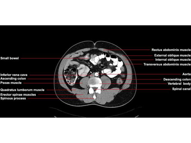 CT Abdomen Axial.pptx