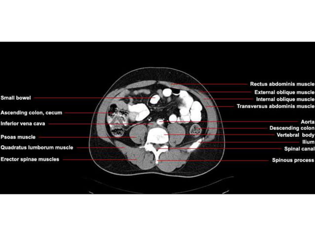 CT Abdomen Axial.pptx