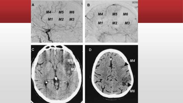 CTA Collateral Scoring system- RADIOLOGY 2 | PPTX | Brain and Nervous ...