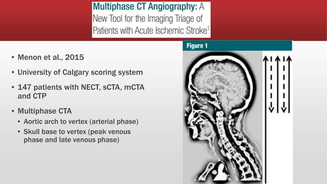 CTA Collateral Scoring system- RADIOLOGY 2 | PPTX | Brain and Nervous ...