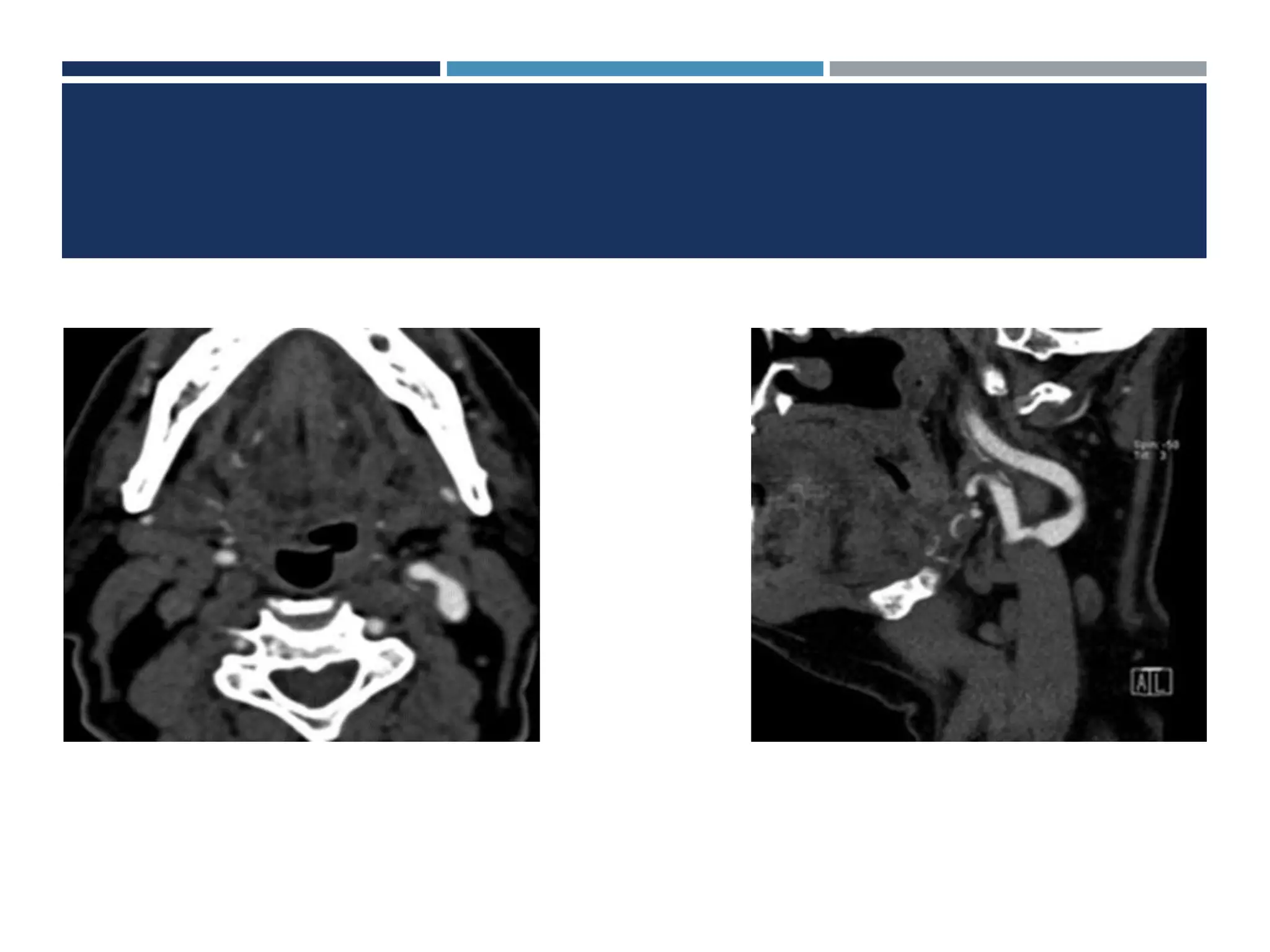 CT Angiography Head and Neck | PPTX