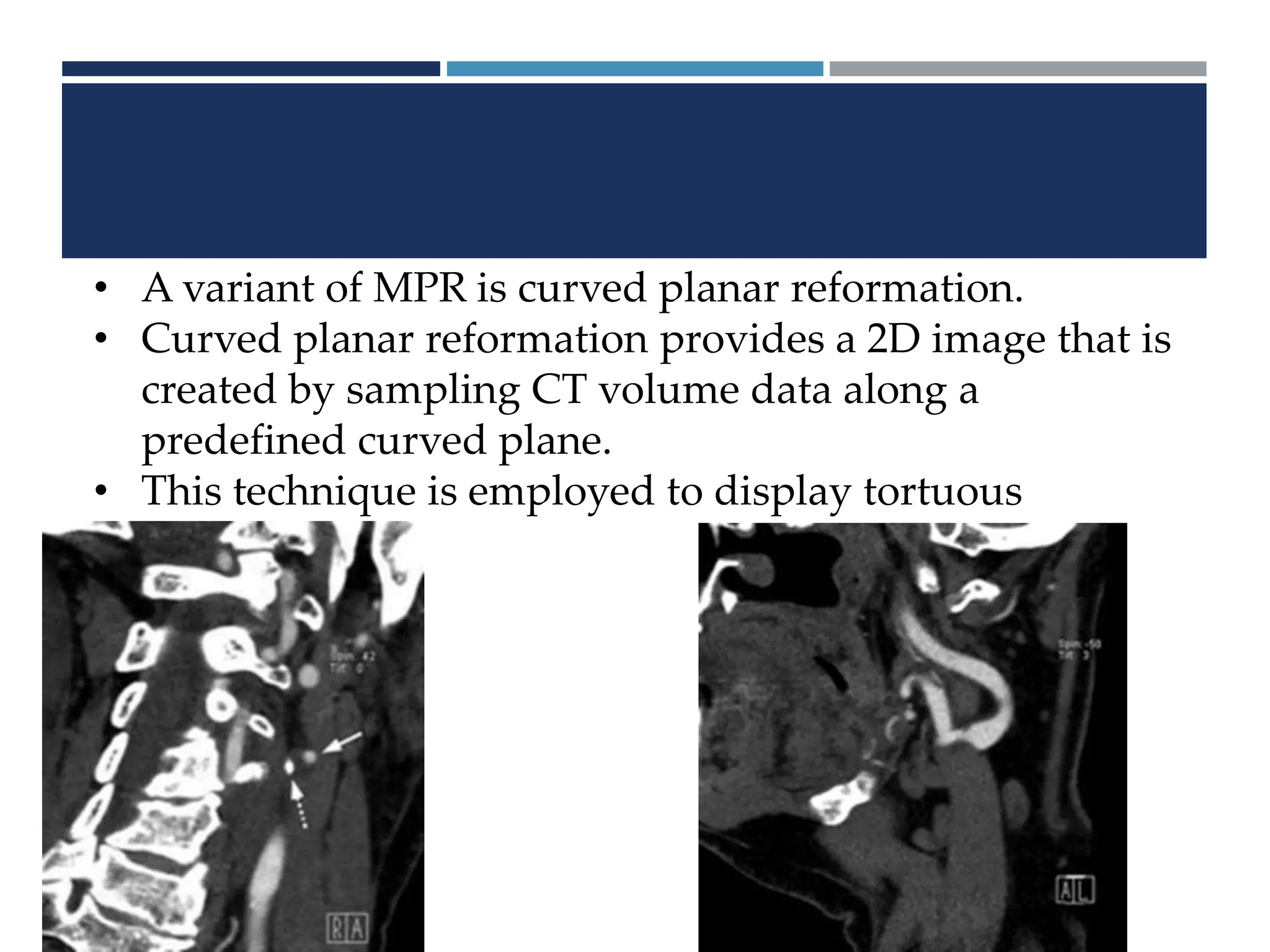 CT Angiography Head and Neck | PPTX
