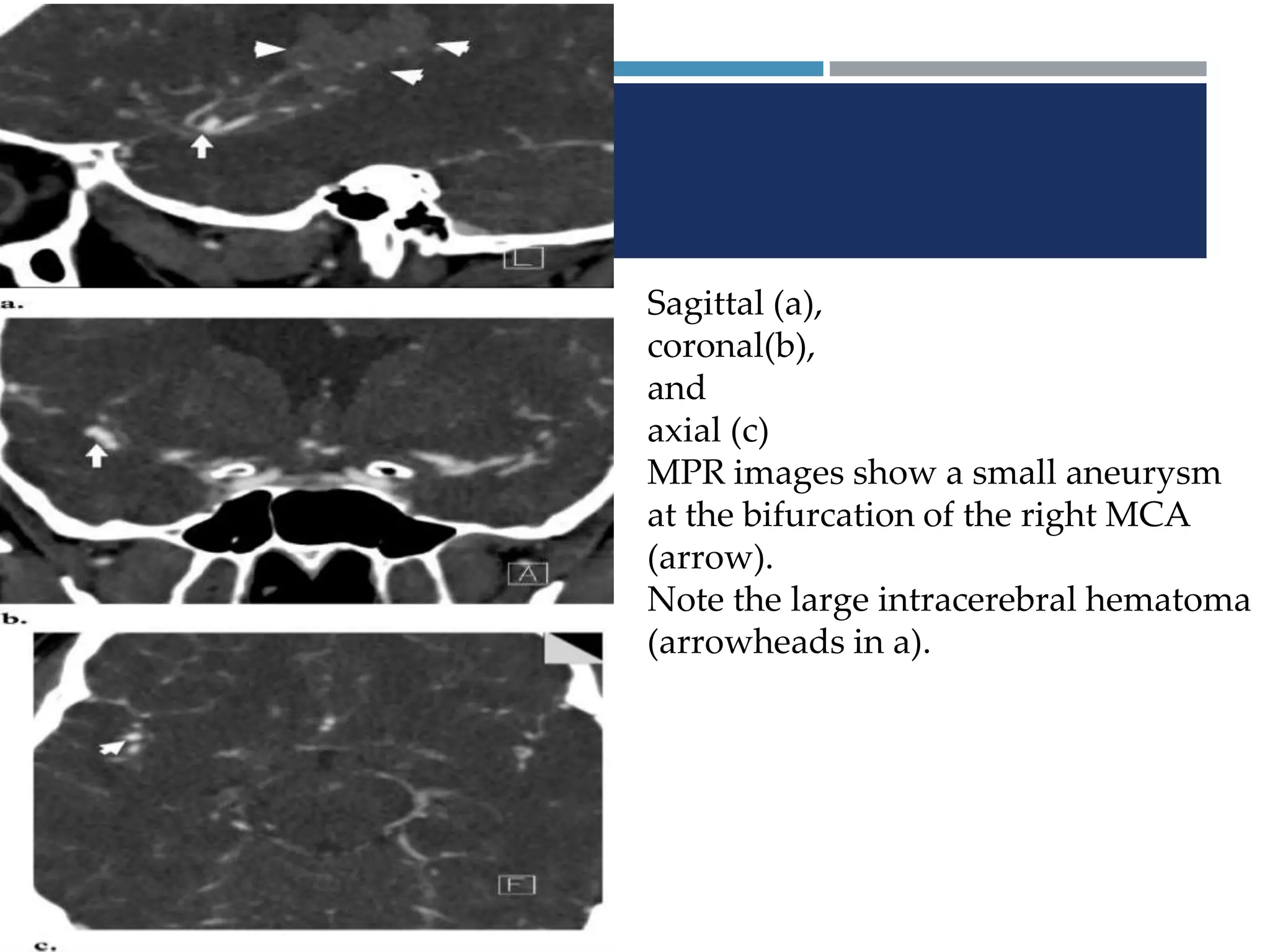 CT Angiography Head and Neck | PPTX