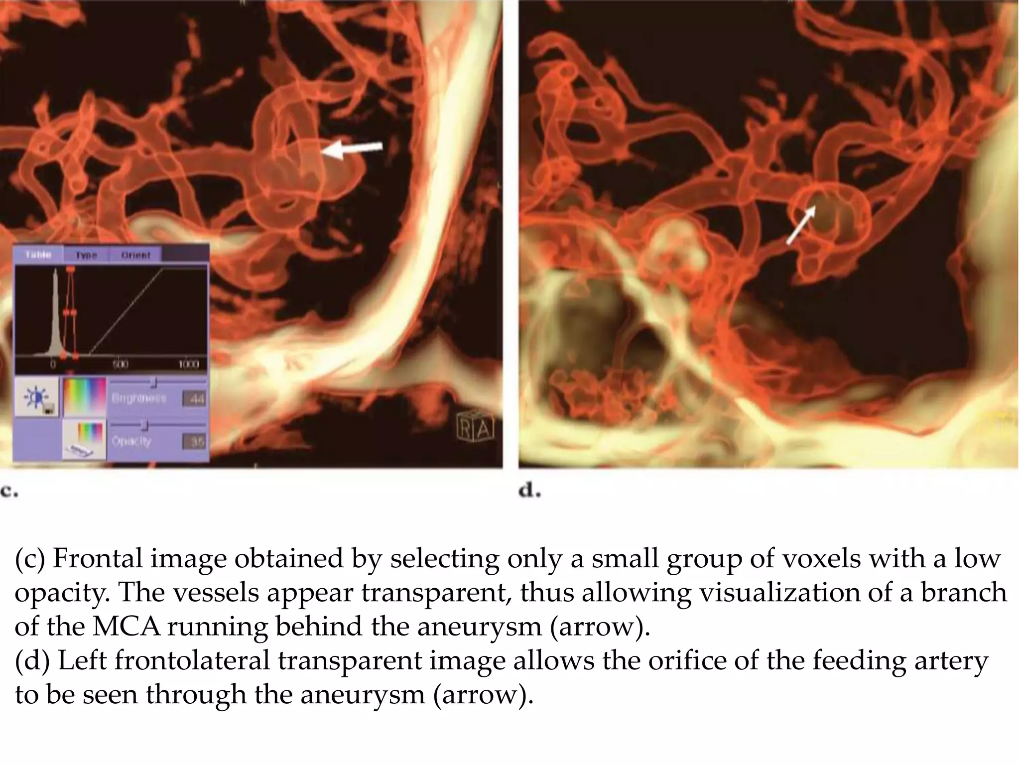 CT Angiography Head and Neck | PPTX