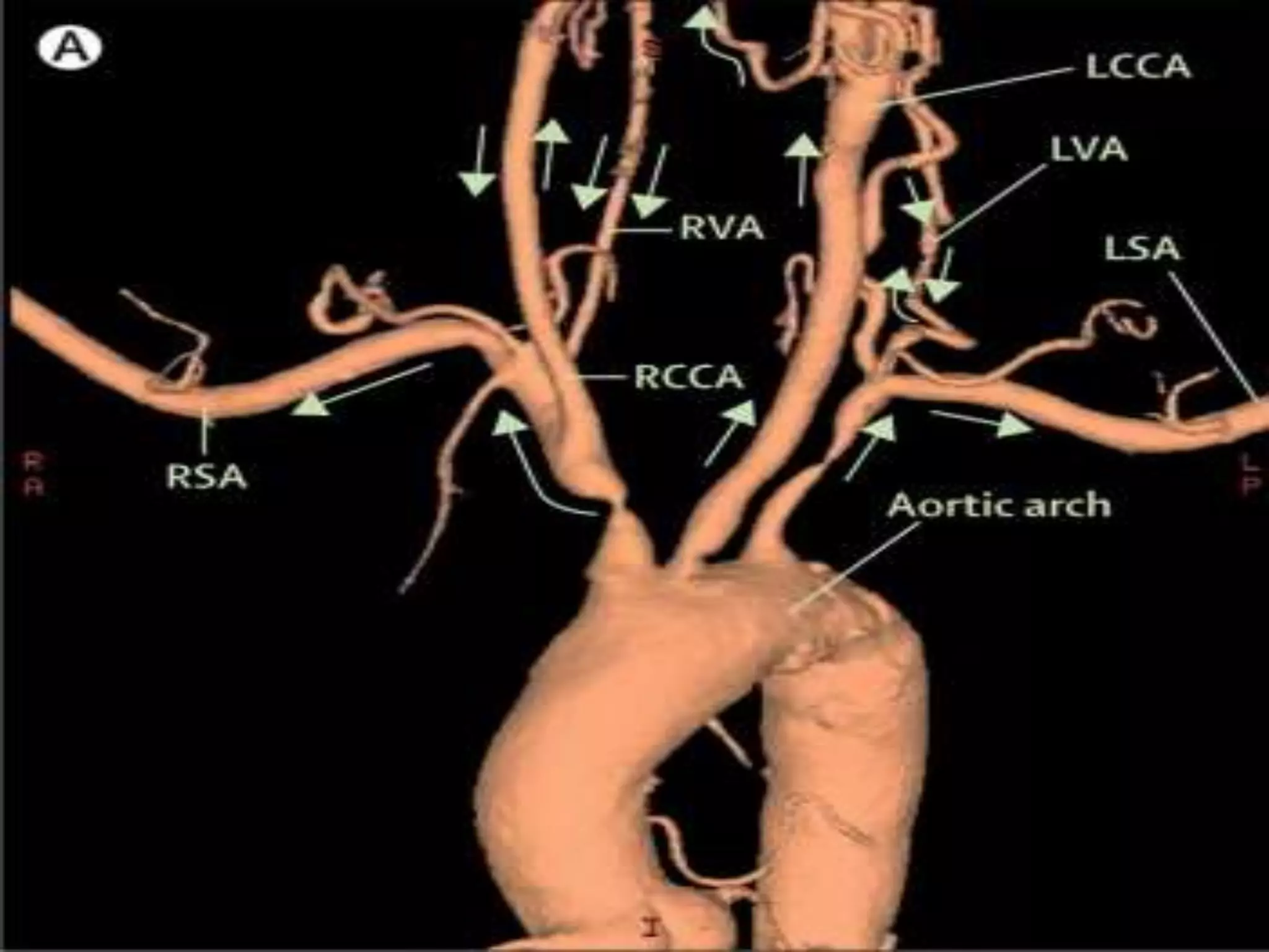 CT Angiography Head and Neck | PPTX