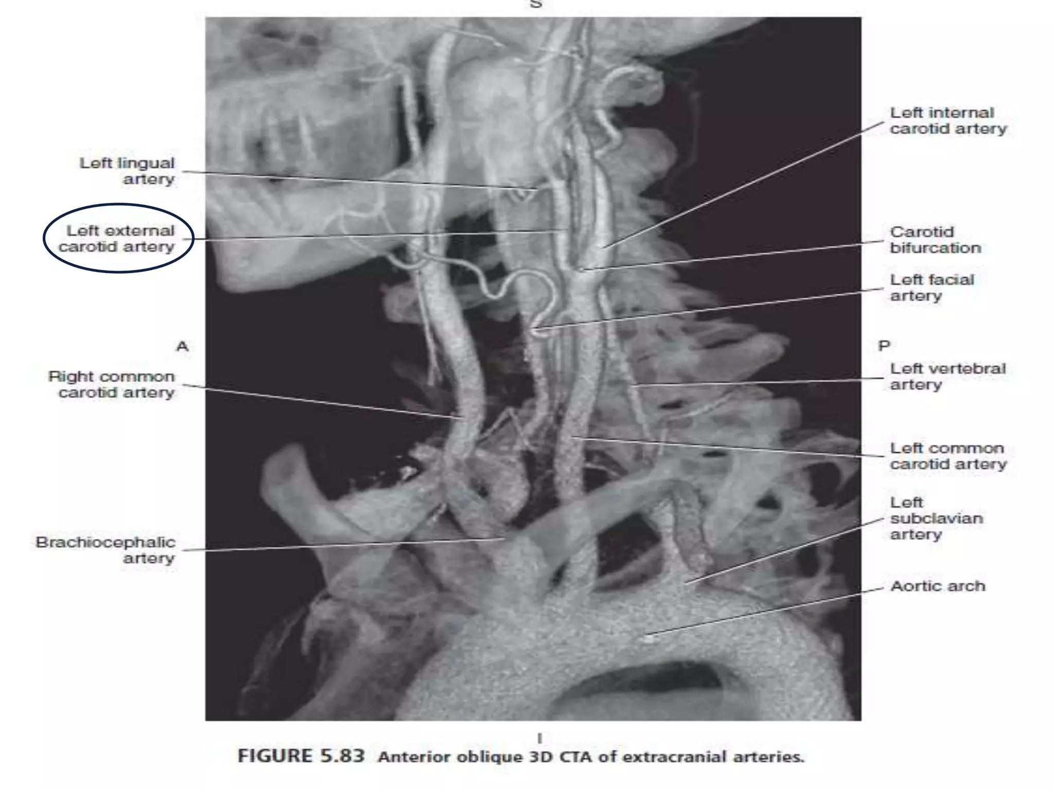 CT Angiography Head and Neck | PPTX