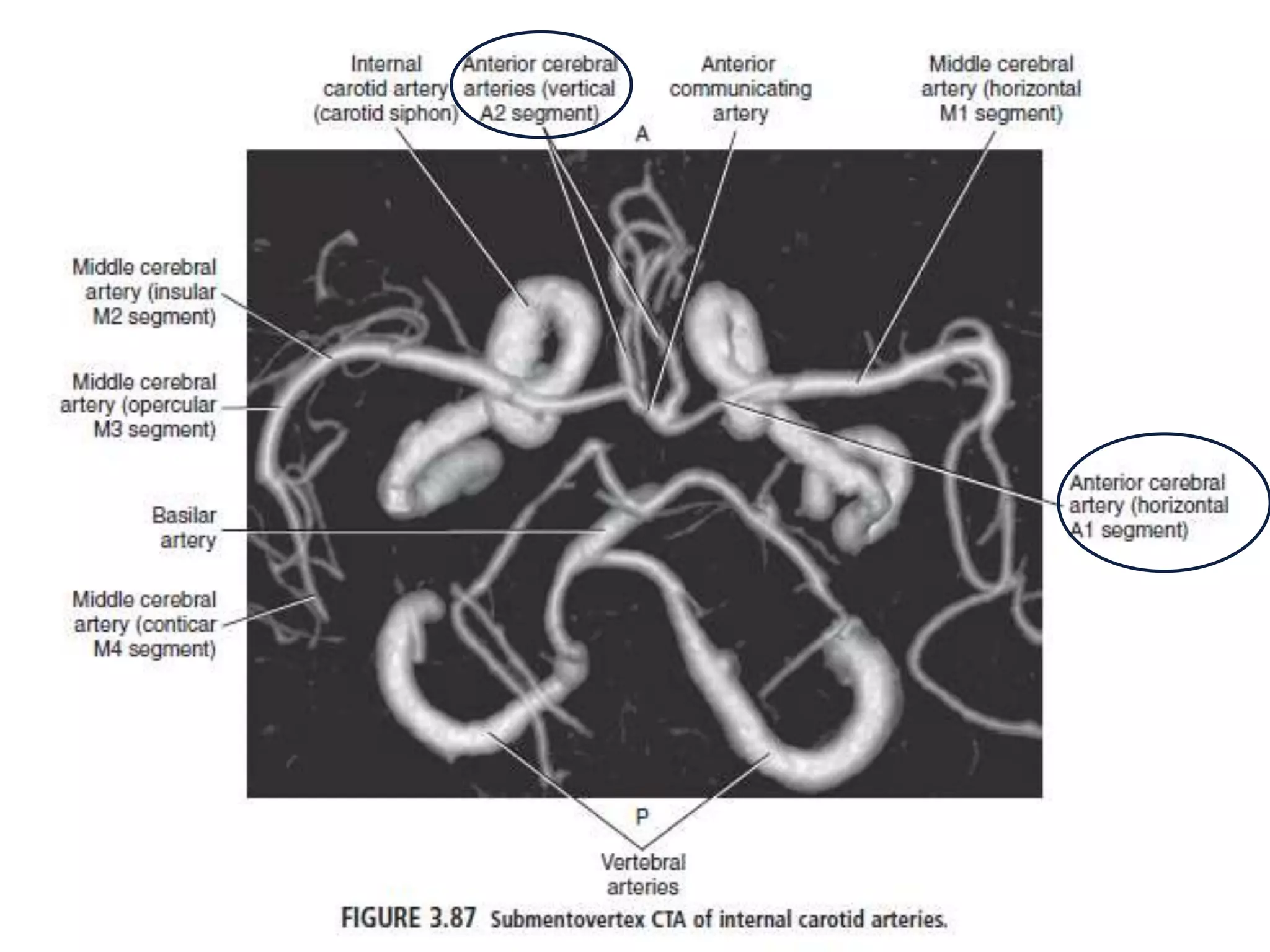 CT Angiography Head and Neck | PPTX