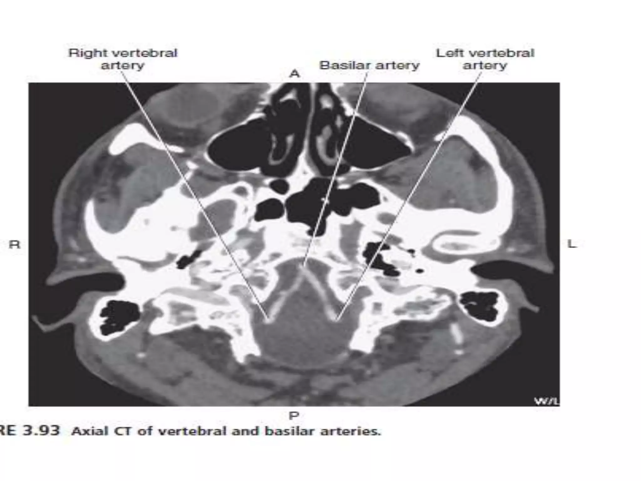 CT Angiography Head and Neck | PPTX