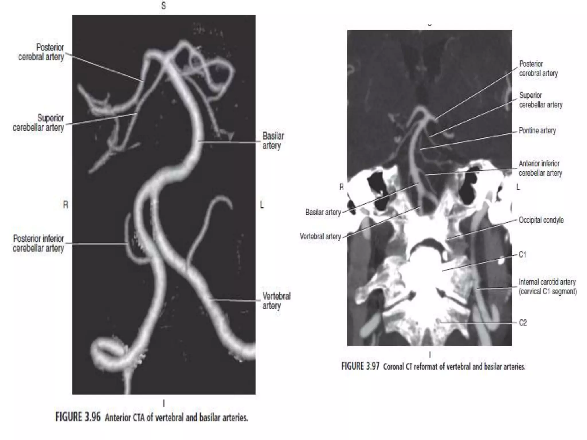 CT Angiography Head and Neck | PPTX