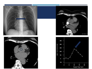 CT Angiography Head and Neck | PPTX