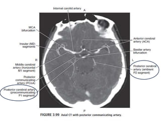 CT Angiography Head and Neck | PPTX