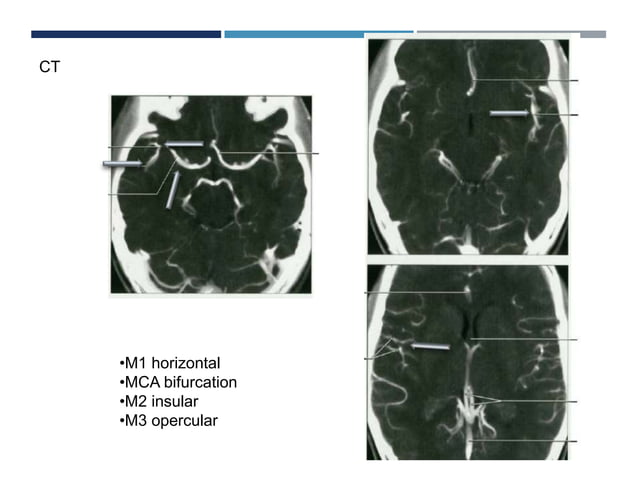 Ct Angiography Head And Neck: Indications And Limitations – JLMPUI