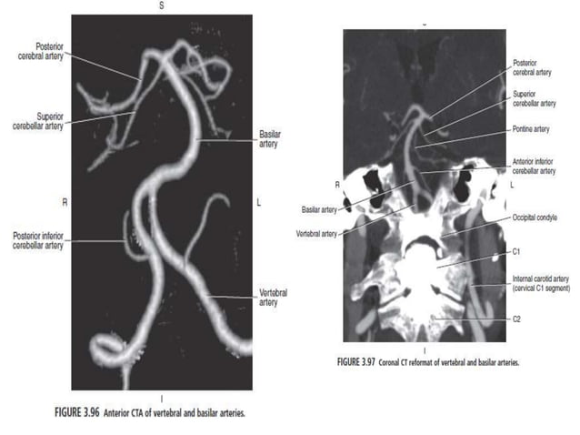 CT Angiography Head and Neck