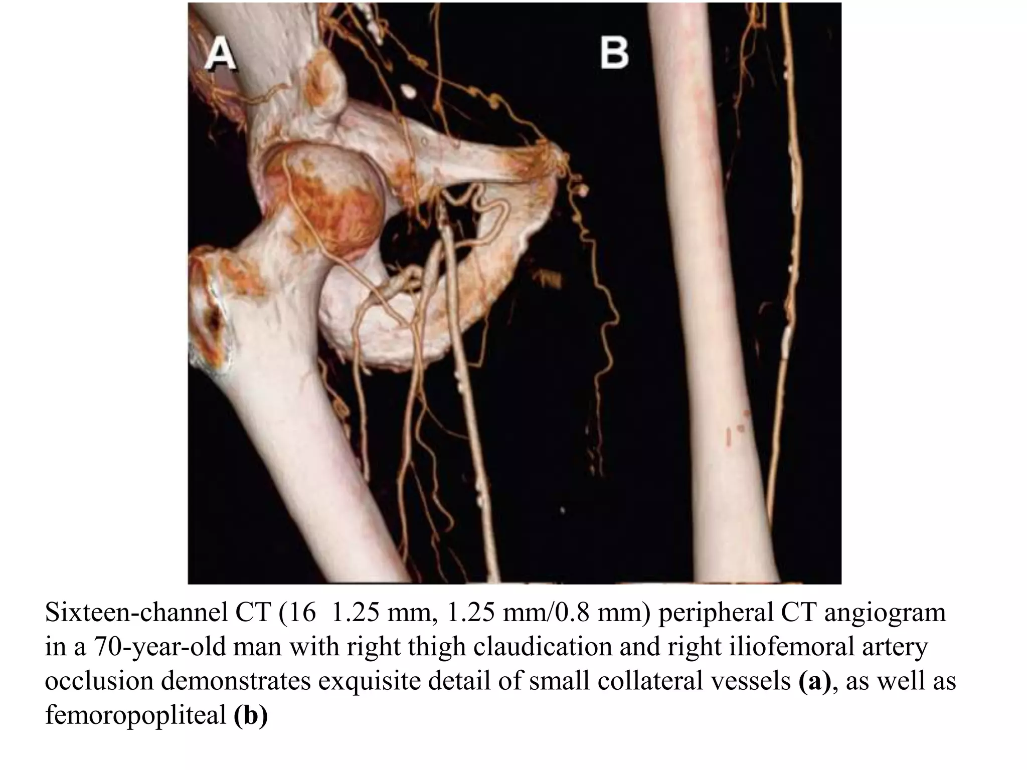 CT Angiography Lower Limb | PPTX