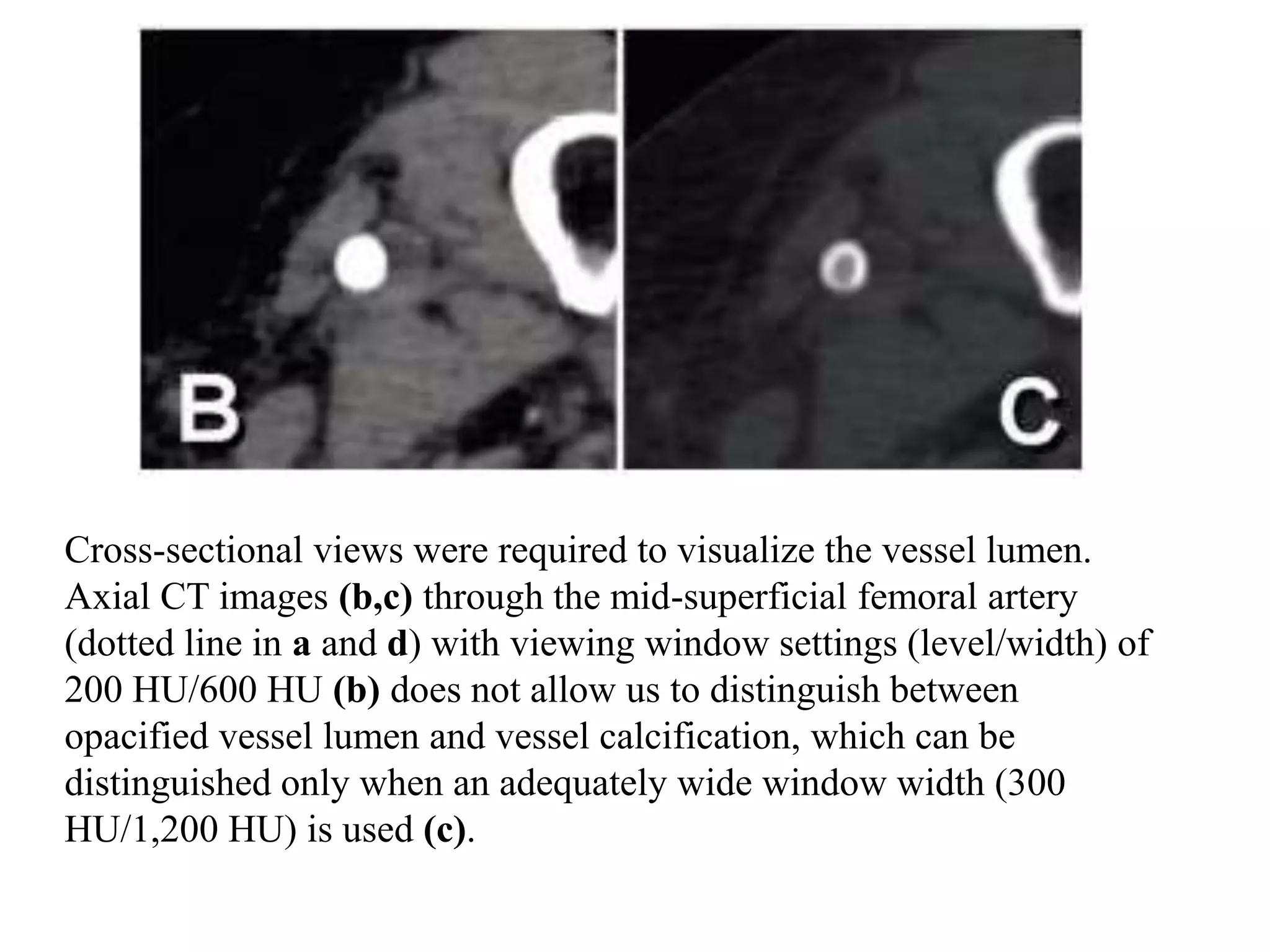 CT Angiography Lower Limb | PPTX